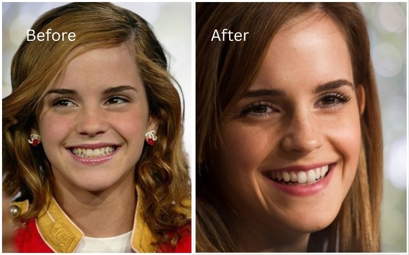 Emma Watson Teeth Science Smile