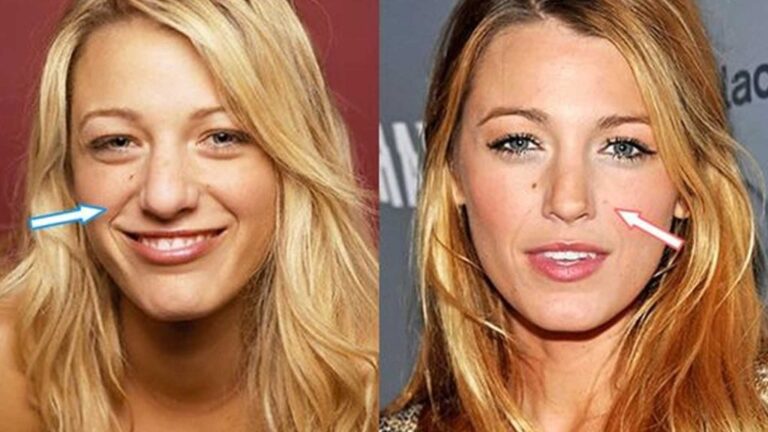 Blake Lively Nose Job Before and After