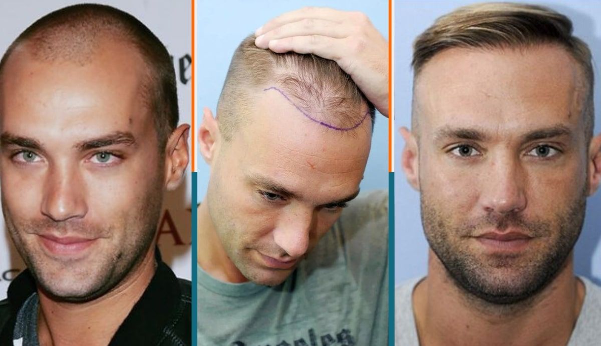 Calum Best Hair Transplant Before After and Hairline Evolution