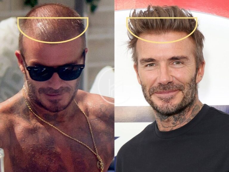 David Beckham Hair Transplant: Before & After His Hairline Recovery