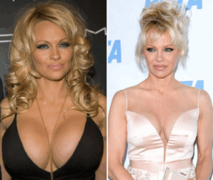Pamela Anderson Breast Implants Before And After Her Iconic Look