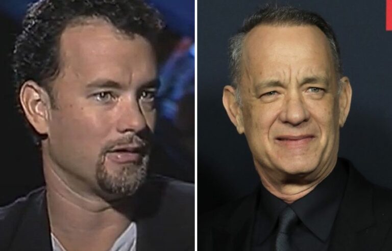 Tom Hanks Hair Transplant: Evolution of Iconic Hollywood Hairline