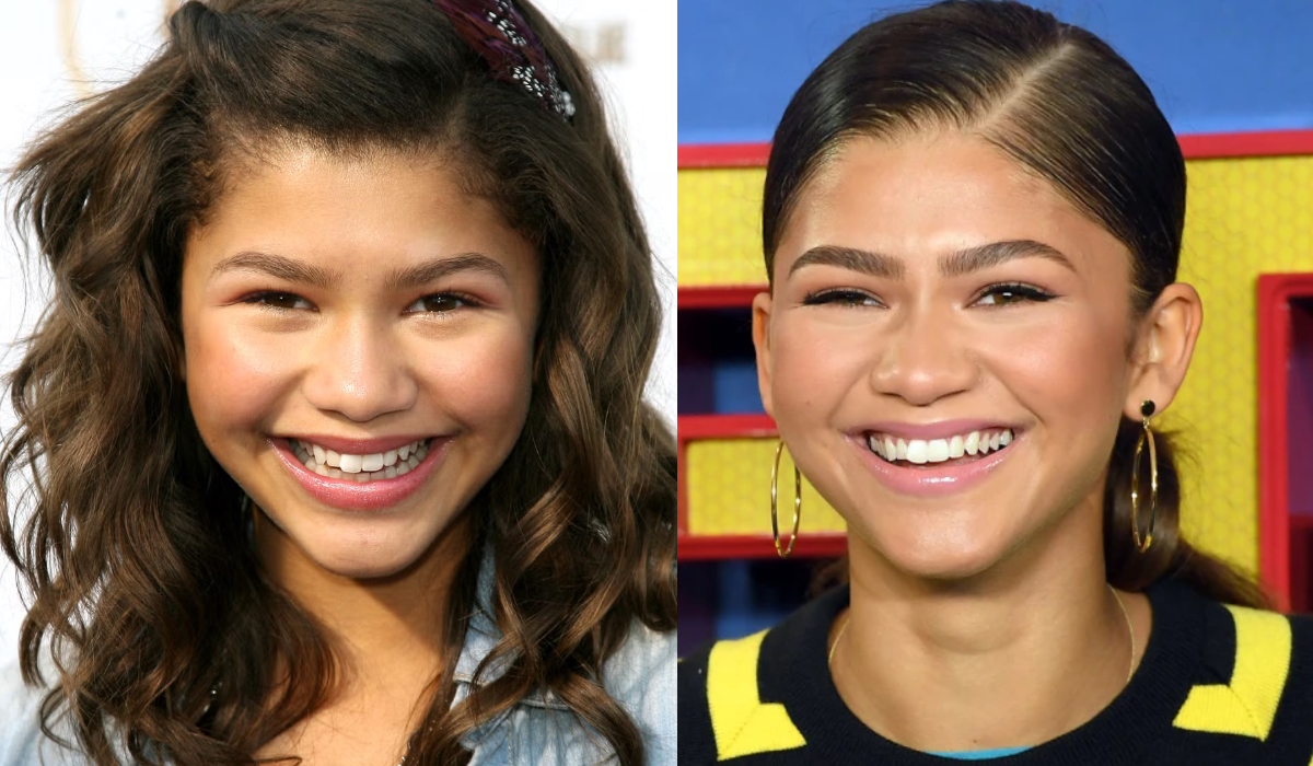 Zendaya Teeth – Veneers & Subtle Smile Transformation